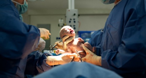 C-Section: What Every Pregnant Woman Should Know - TopWomenMagazine